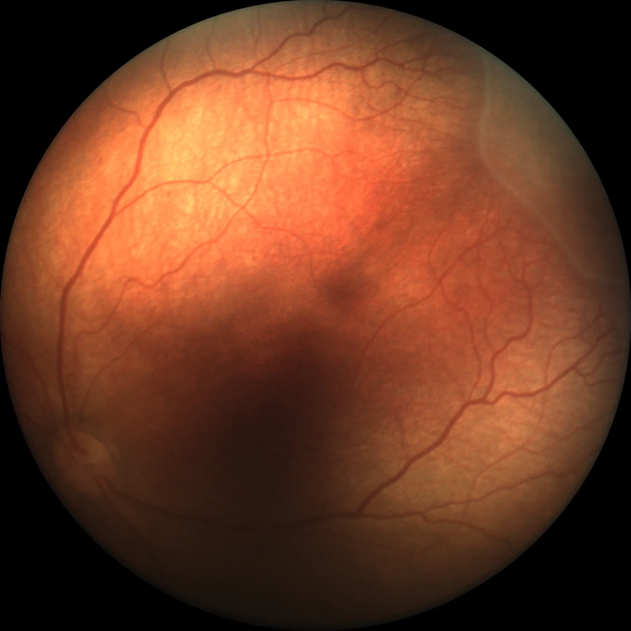 ICON Retinal Imaging System